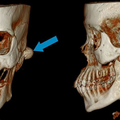 Clinical Photograph Shows A Left Postauricular Swelling Download
