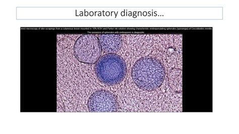 Dimorphic Systemic Mycosespptx