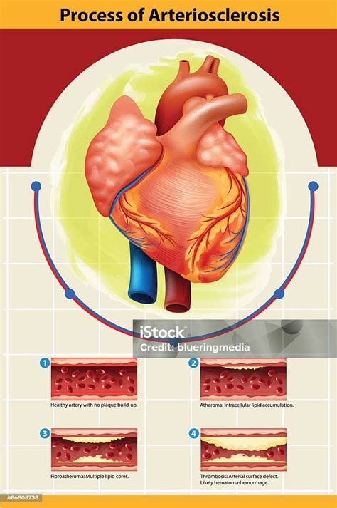 Poster Proses Arteriosklerosis Ilustrasi Stok Unduh Gambar Sekarang