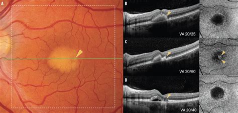 Vitelliform Lesion