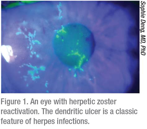 Serum Eye Drops Corneal Ulcer At Jesse Mcmorrow Blog