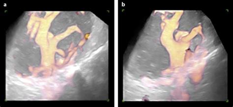 A B 3d Power Doppler Showing The High Vascularization Of Ovarian Tumor