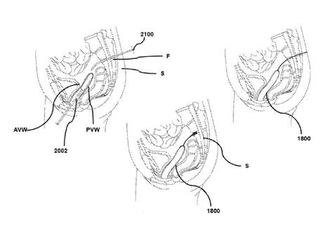 Patent Drawing Samples Professional Patent Drawings