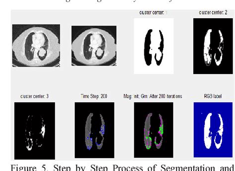 Figure 5 From Lung Lesion Detection In Ct Scan Images Using The Fuzzy Local Information Cluster