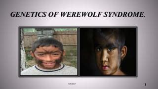 Genetics Of Congenital Generalized Hypertrichosis Pptx