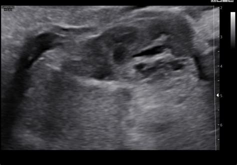 Neuroblastoma Ultrasound