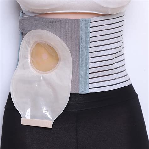 Colostomy Bag Hernia At Ruby Ethel Blog