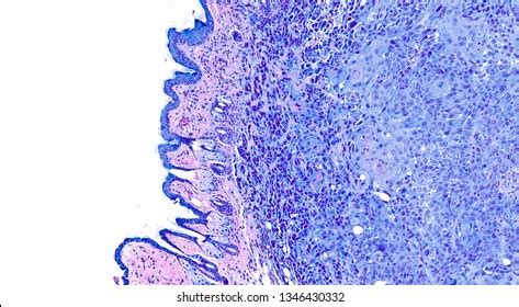 Oral Cancer Biopsy Images Stock Photos D Objects Vectors Shutterstock