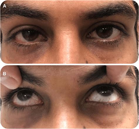 Postoperative Photographs In The Primary Gaze A And Supraduction B