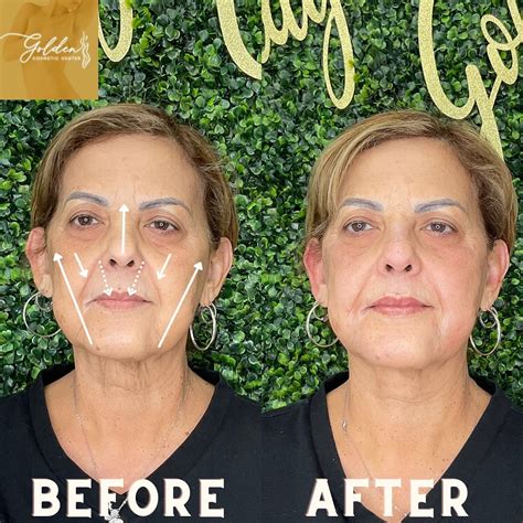 Look At These Amazing Pdo Golden Cosmetic Center