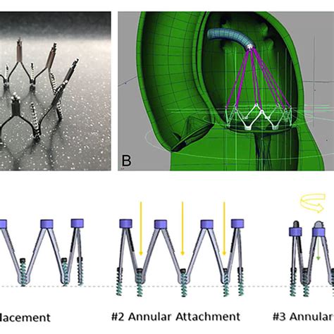 Procedural Steps For The Implantation Of The Edwards Pascal Download Scientific Diagram Procedural Steps For The Implantation Of The Edwards Pascal Download Scientific Diagram