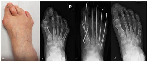 Forefoot Deformities In Patients With Rheumatoid Arthritis Mid To