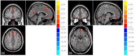 Tt Homozygotes Showing Higher Reho Values For The Bilateral Mpfc A Download Scientific