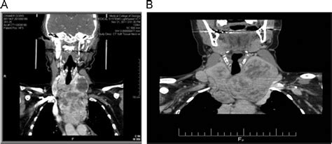 Substernal Thyroidectomy The Transcervical Approach Operative Techniques In Otolaryngology