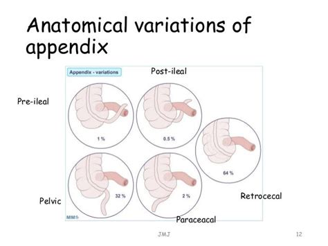 Acute Appendicitis