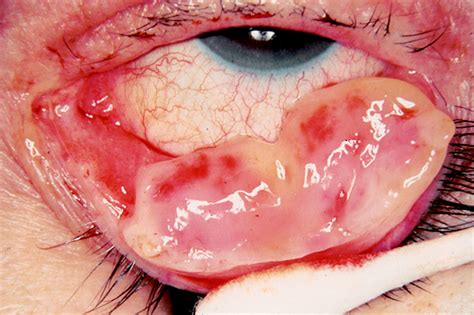 Ligneous Conjunctivitis