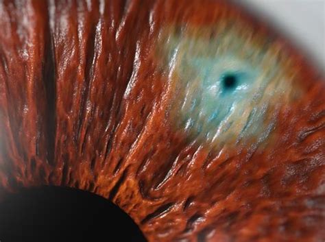 Video Laser Peripheral Iridotomy Lpi Healthclips Online