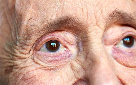 Facilitating Cataract Diagnosis To Reduce Preventable Blindness