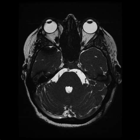 Neurovascular Compression Syndrome Trigeminal Nerve Radiopaedia 89835 106947 Axial Fiesta