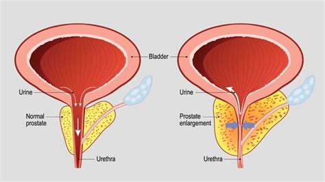 What Is Benign Prostatic Hyperplasia