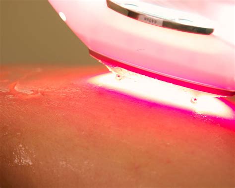 Bioflex Laser Therapy In Vaughan Osteoklinika