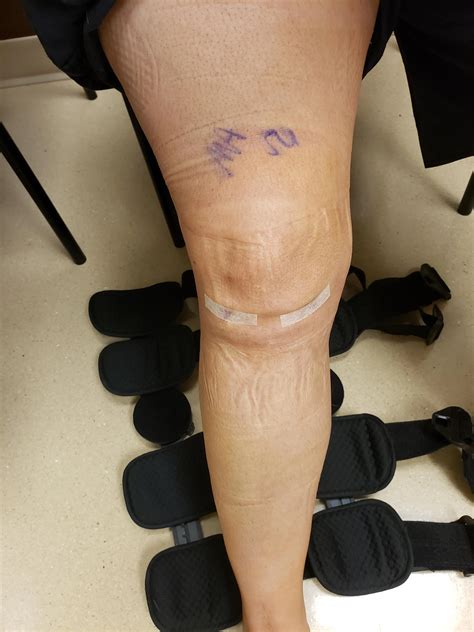 24 Hours Post Op Microfracture Surgery Scrolller