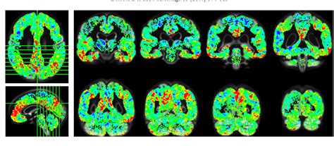 Figure 4 From Predictive Markers For Ad In A Multi Modality Framework An Analysis Of Mci