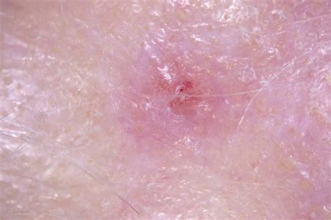 Skin Cancer White Spots On Face Cancerwalls