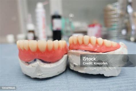 Prostesis Gigi Yang Dapat Dilepas Lengkap Pada Model Gipsum Foto Stok
