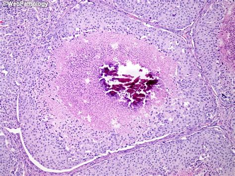 Medullary Thyroid Carcinoma