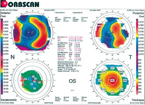Slit Scanning Corneal Topography Orbscan By Orbtek Bausch And Lomb