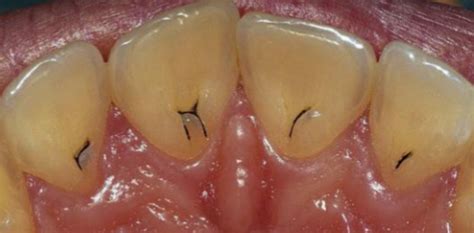 Kcs Non Invasive Management The Primary And Young Flashcards Quizlet