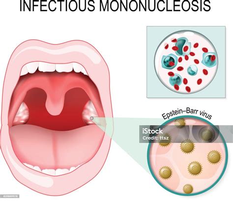 Vetores De Mononucleose Infecciosa E Mais Imagens De Mononucleose