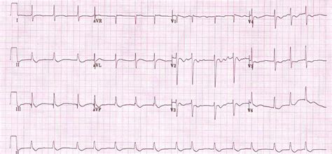 Digoxin Salvador Dali Mustache Ecg Digoxin Salvador Dali Mustache Ecg
