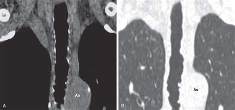 Bronchiolitis Radiology Key