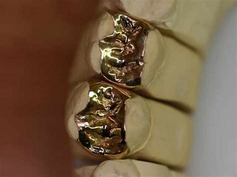 Füllungsmaterialien | Denta Beaute Zahnmedizin