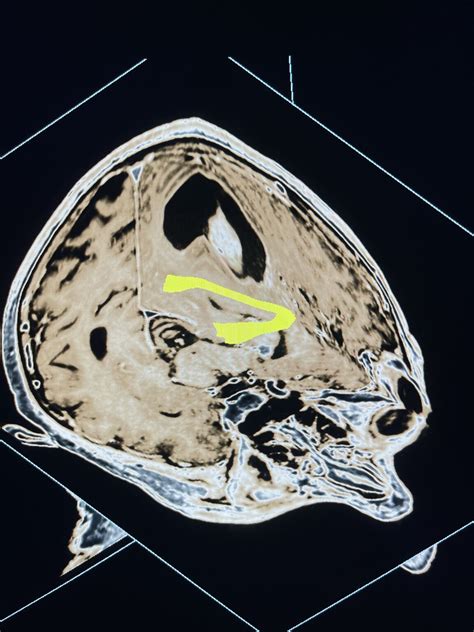 khaled gad on linkedin dti tractography ibnsinahospital kuwait