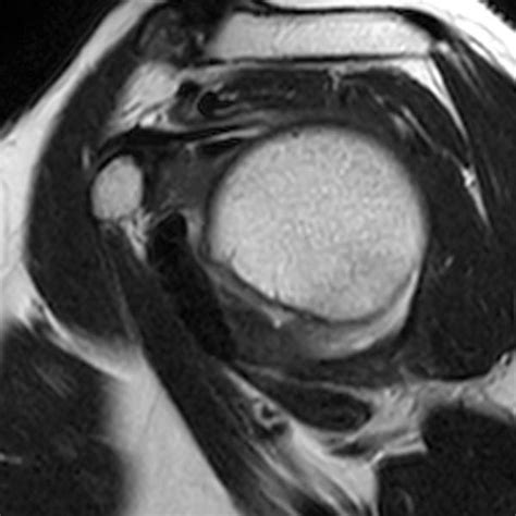 Coracohumeral Ligament Mri