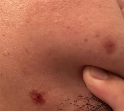 Popped This Pimple Now Super Red What Do I Do Rpimplecommunity