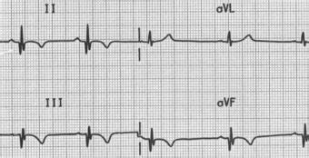 Q Wave • Litfl • Ecg Library Basics