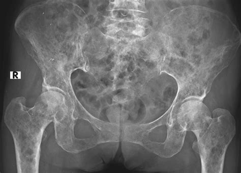 Multiple Myeloma X Ray