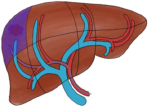 Radioembolization For Hepatocellular Carcinoma Updated Strategies And