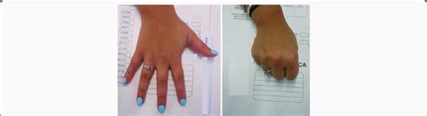 Final Result Reveals Extensor Tendon Maintains A Central Position Over Download Scientific