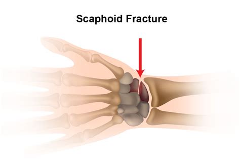 Scaphoid Fracture Austin Tx Dr Gregg A Vagner