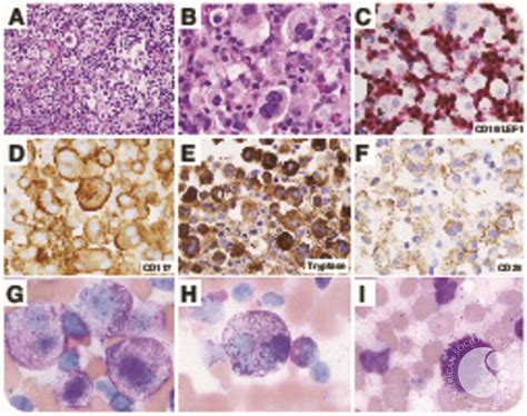 Aleukemic Mast Cell Leukemia Associated With Chronic Myelomonocytic