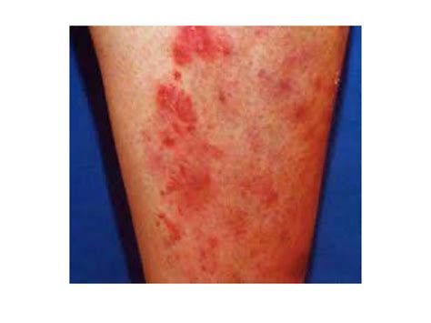 Dermatophyte Infection 2pptx Skin And Dermatology Diseases And