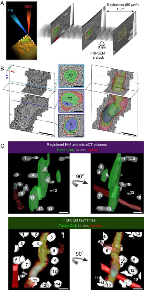 Fib Sem Imaging Of A Tumor Cell Arrested In The Vasculature Of The