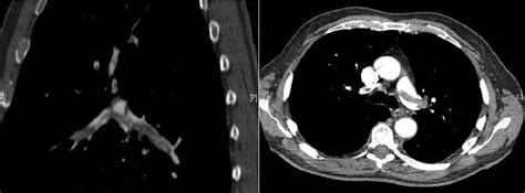 Pulmonary Embolism Pe Causes Symptoms And Treatment