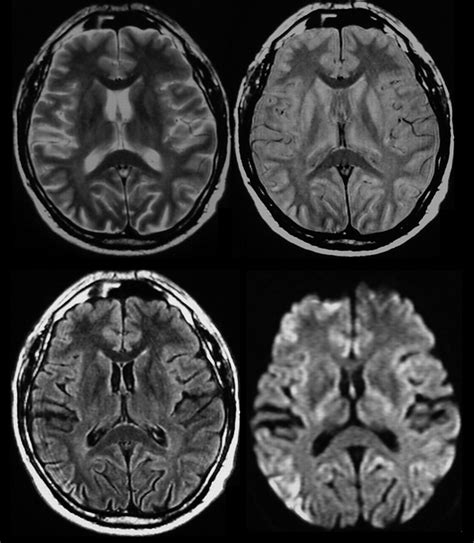 Creutzfeldt Jakob Disease Brain
