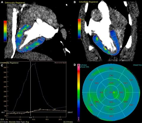 Dynamic Perfusion Acquisition At 70 Kv Fused Mbf Map And Ct Images